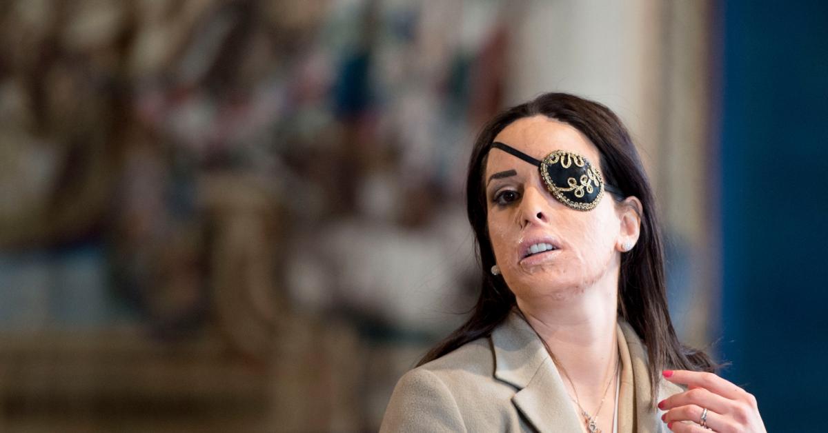 Gessica Notaro, l'occhio sinistro tornerà a vedere: "Farò un trapianto ...