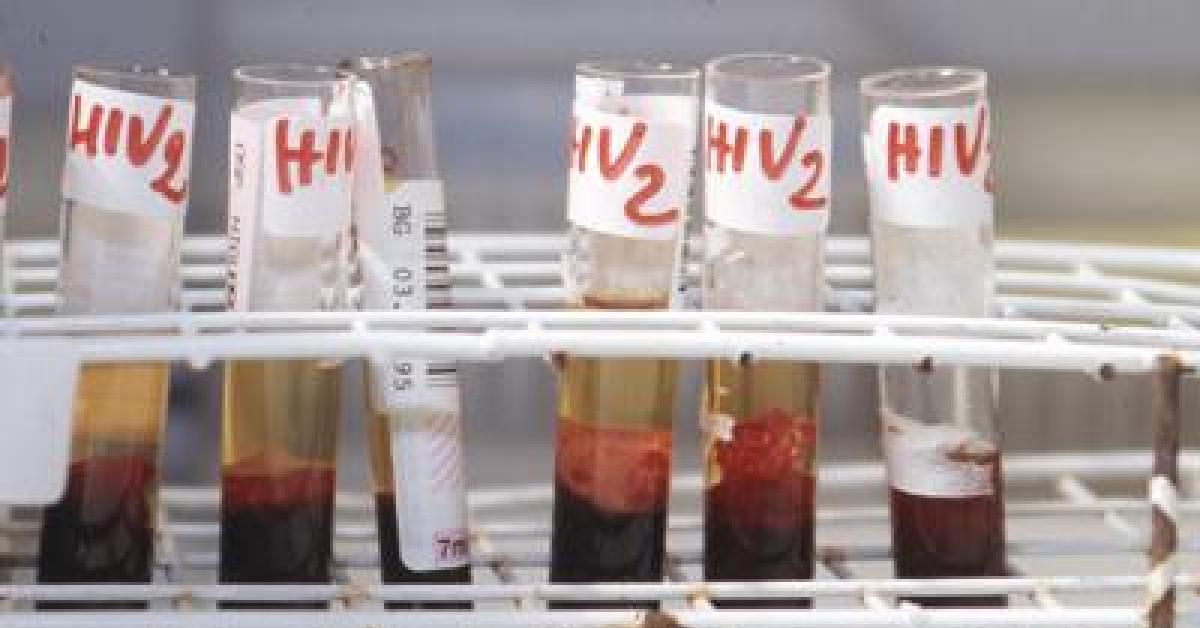 Aids, 840mila Sos in 37 anni al Telefono verde Iss, stigma paura numero uno - Il Giornale d'Italia