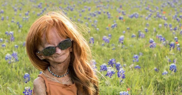 Adalie Rose causa morte: cos'è la progeria, la malattia di Benjamin ...